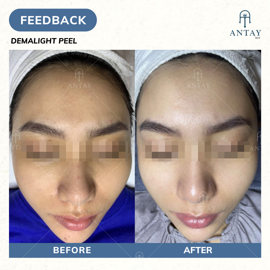 Dermalight Peel | AnTay Spa