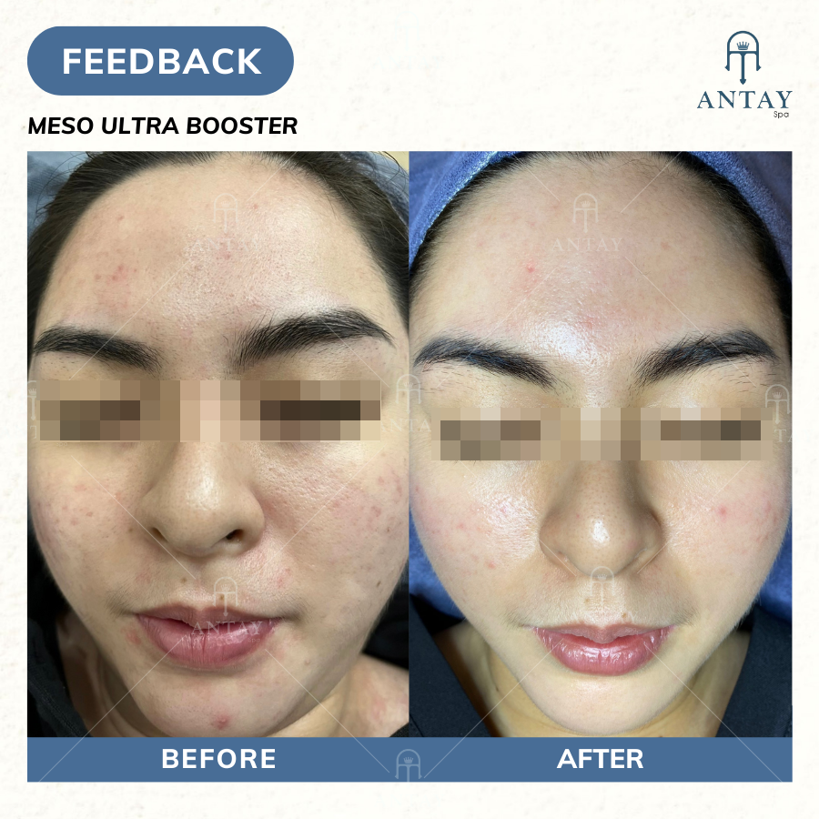Meso Ultra Booster | AnTay Spa